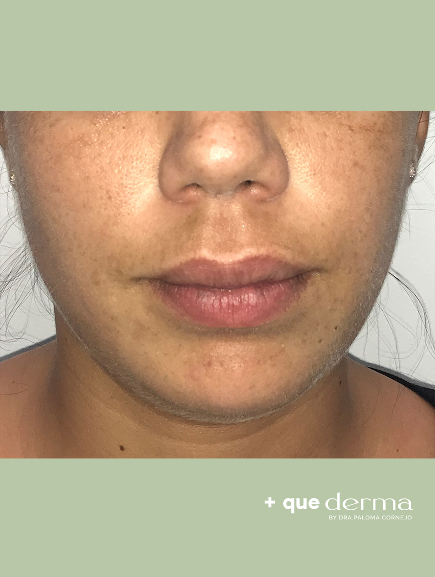¿Qué es el melasma?
